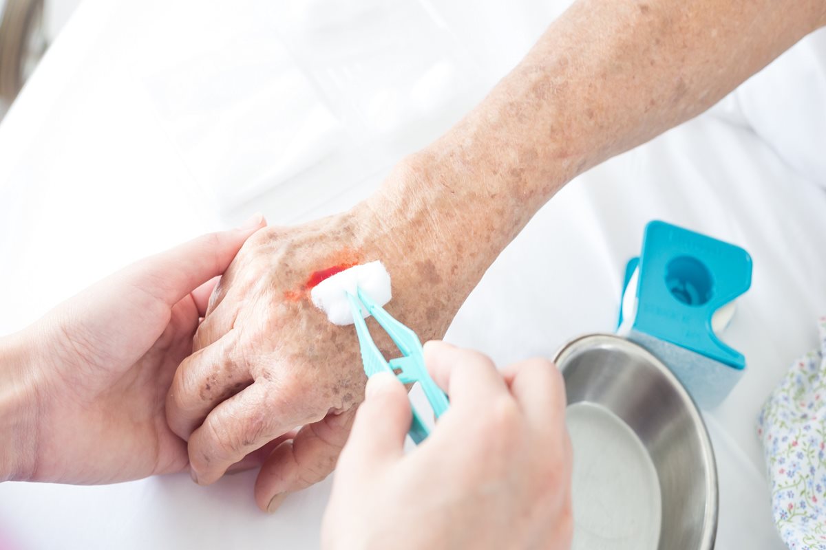 Opieka pielęgniarska w ranach i ranach… - Publikacja | Adamed Expert