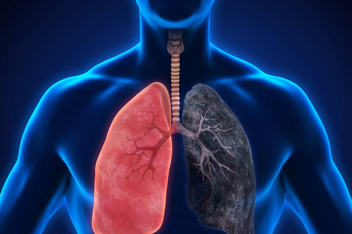 Rozedma płuc - Publikacja | Adamed Expert