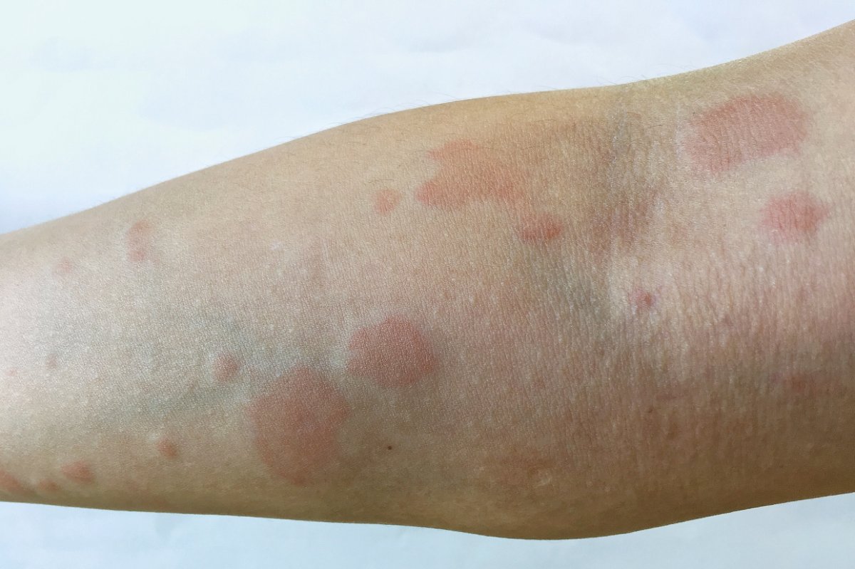 Liszaj rumieniowaty - rodzaje i… - Publikacja | Adamed Expert