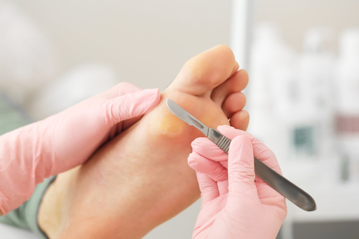 Modzele, nagniotki, odciski – czym są i… - Publikacja | Adamed Expert